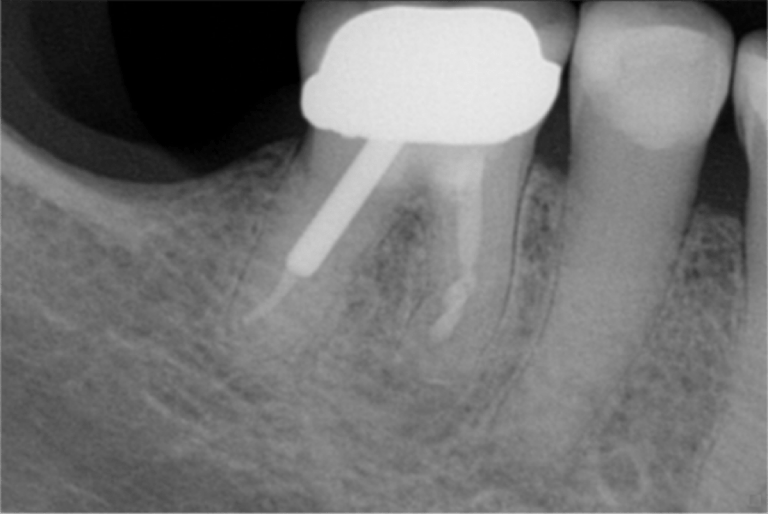 ENDODONTIC MICROSURGERY - Centre Endodontique Saint Laurent